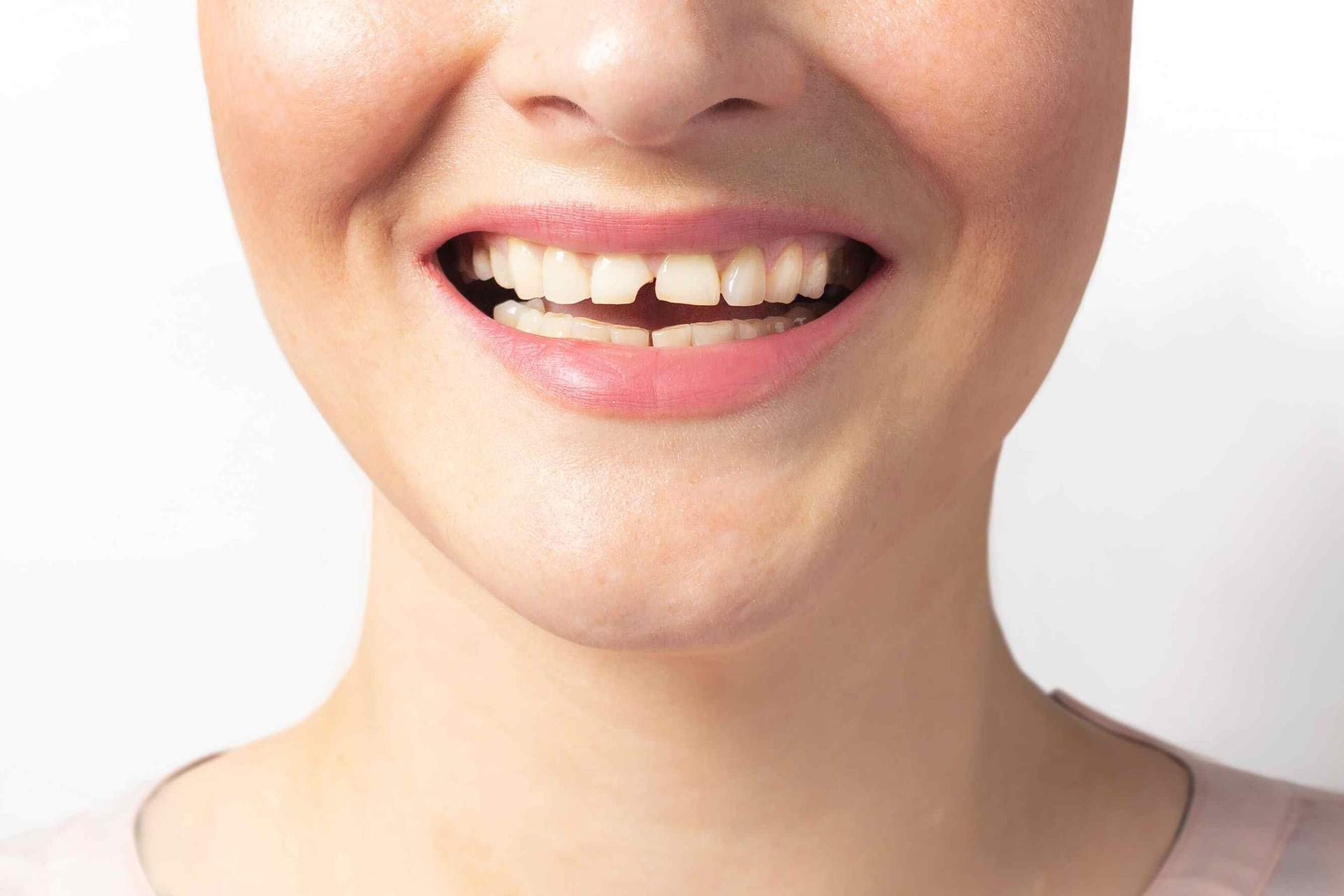 Ways to Fix a Chipped Tooth and Maintain Oral Health